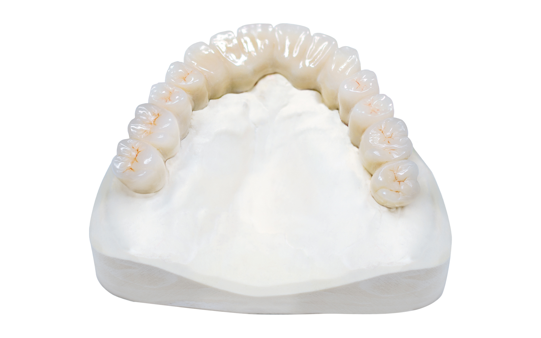 Teleskopversorgungen/Teleskopprothesen | permadental