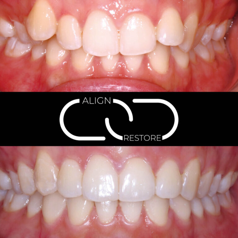 Align & Restore | permadental