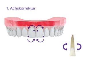 TrioClear Aligner | permadental